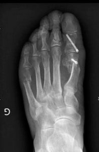 Quintus Varus - PiedVar