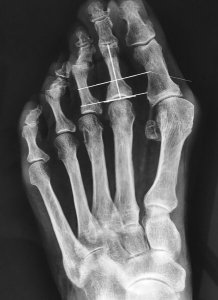 Quintus Varus - PiedVar